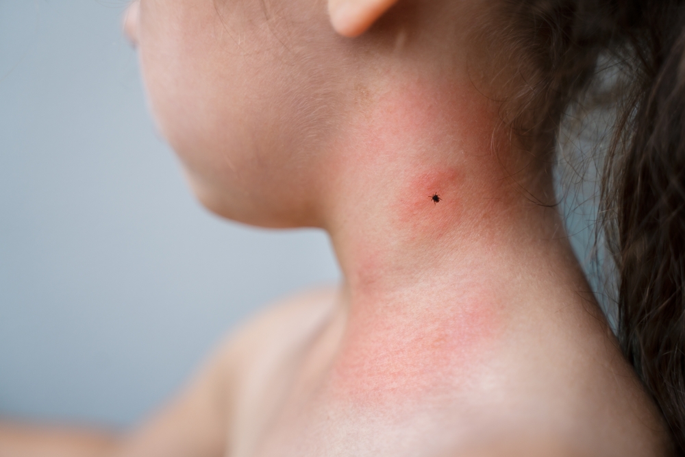 „Boala Lyme este supradiagnosticată. Dacă căpușa este scoasă în primele ...